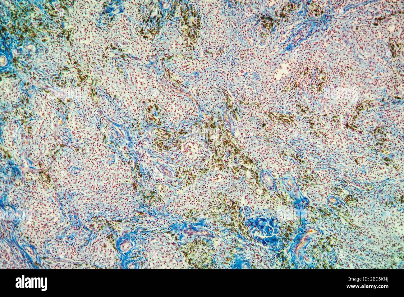 Foreign body granuloma tissue under the microscope 100x Stock Photo - Alamy