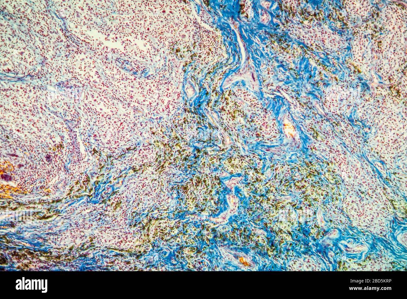 Foreign body granuloma tissue under the microscope 100x Stock Photo - Alamy