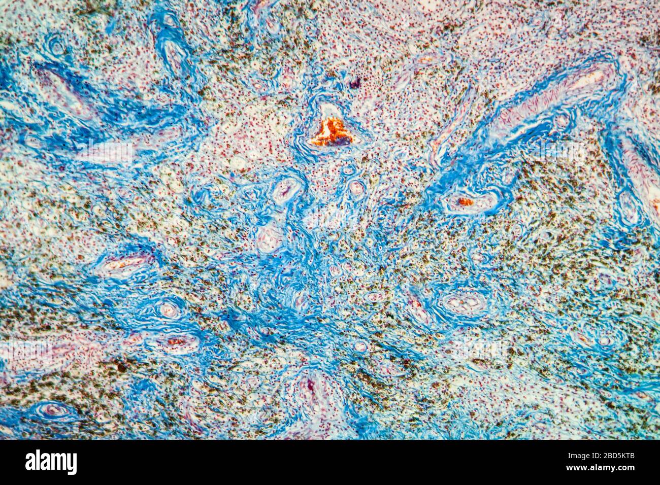 Foreign body granuloma tissue under the microscope 100x Stock Photo - Alamy