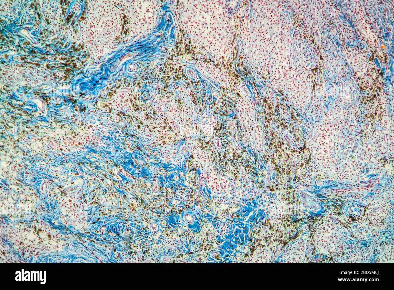Foreign body granuloma tissue under the microscope 100x Stock Photo - Alamy