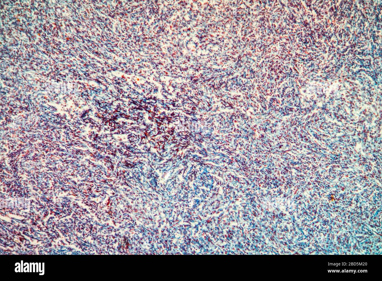 Cancer of the gallbladder tissue under the microscope 100x Stock Photo ...