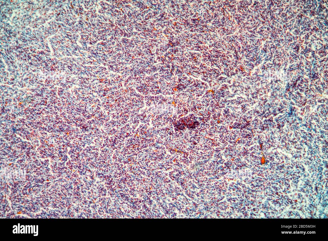 Cancer of the gallbladder tissue under the microscope 100x Stock Photo ...