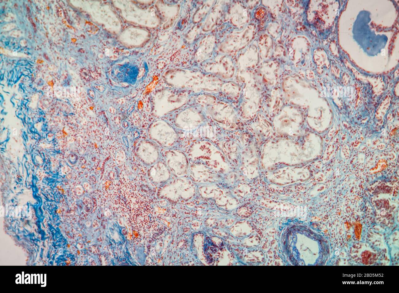Atrophy kidney tissue under the microscope 100x Stock Photo - Alamy