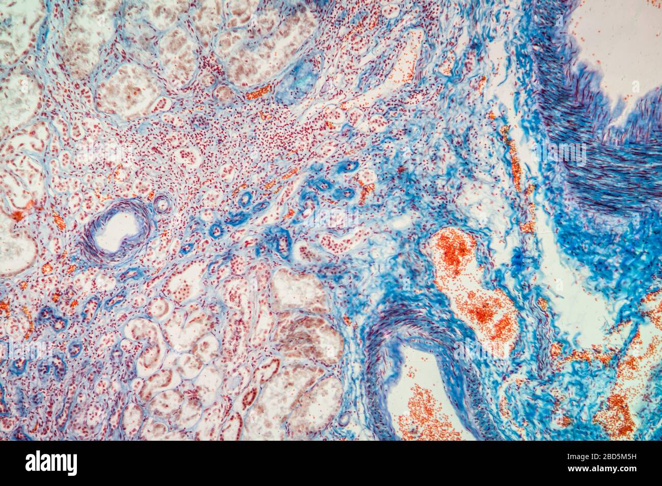 Atrophy kidney tissue under the microscope 100x Stock Photo - Alamy