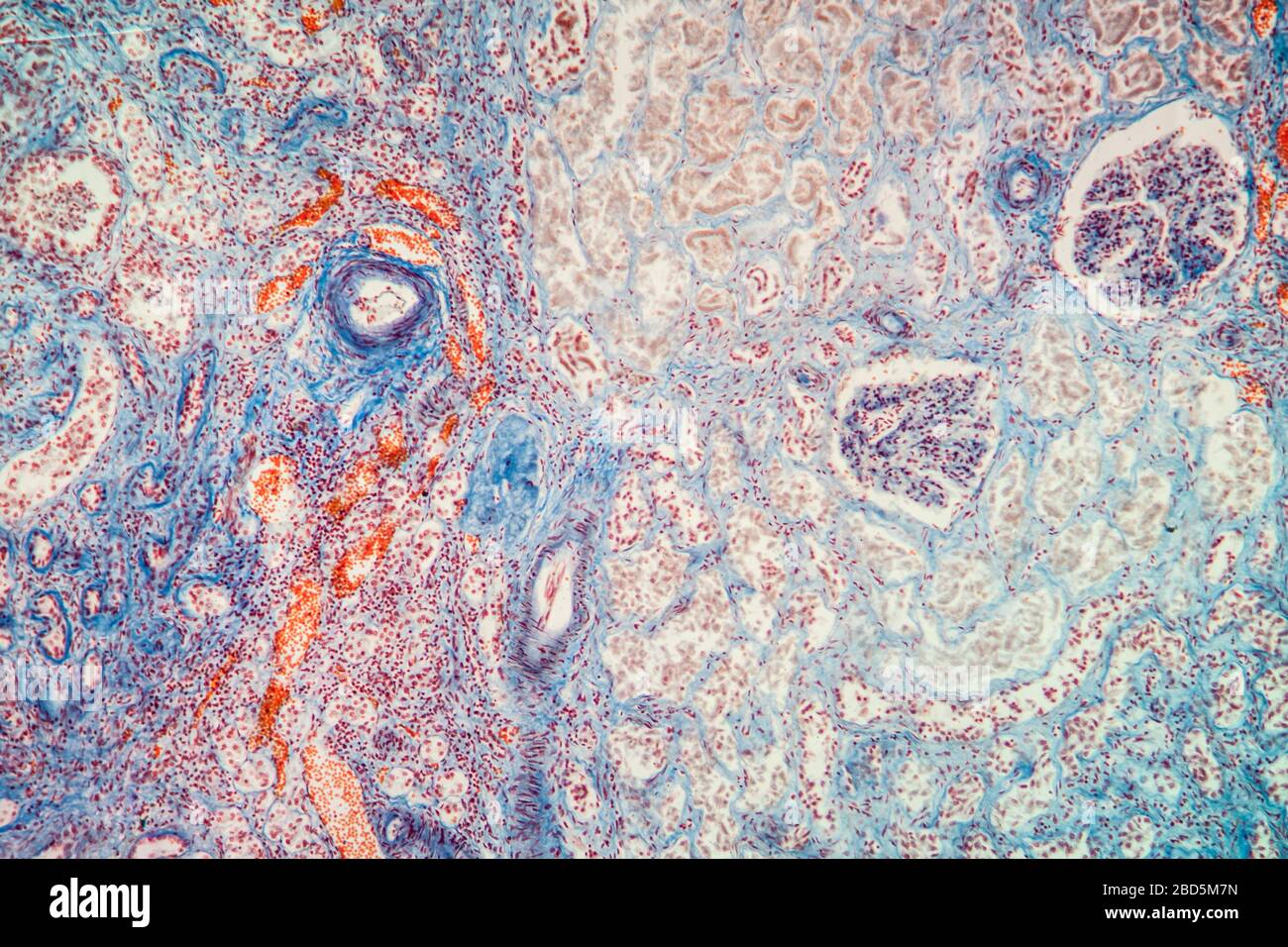 Atrophy kidney tissue under the microscope 100x Stock Photo - Alamy