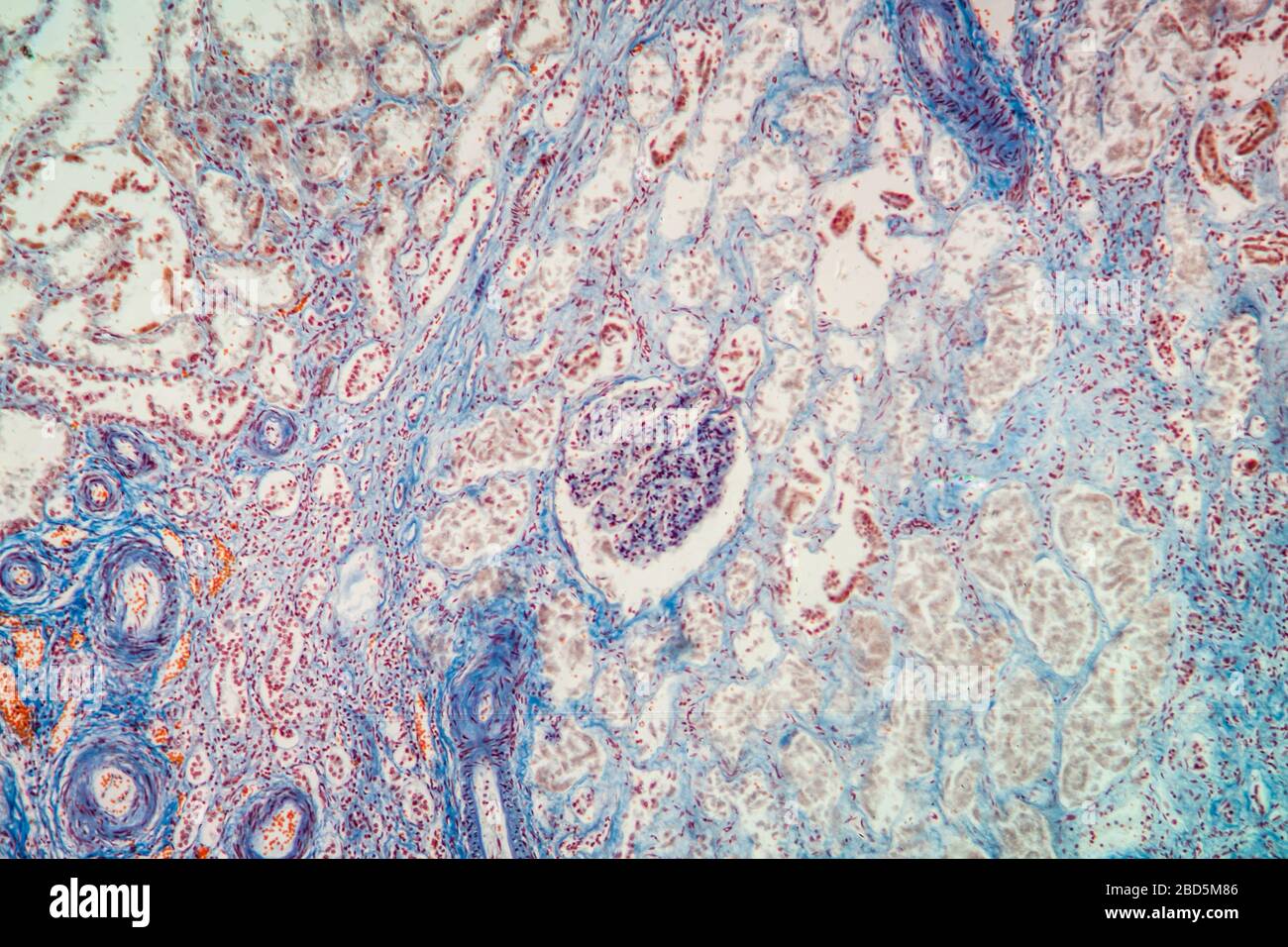 Atrophy kidney tissue under the microscope 100x Stock Photo - Alamy