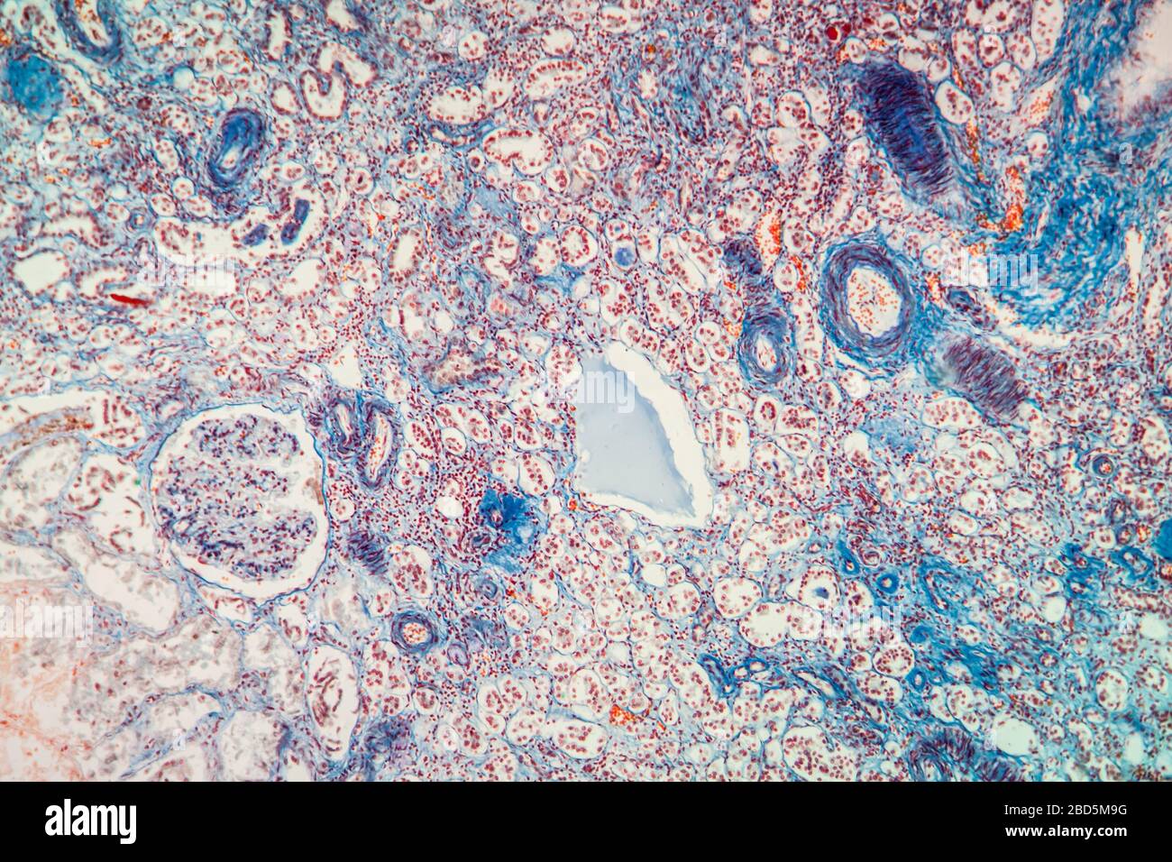 Atrophy kidney tissue under the microscope 100x Stock Photo - Alamy