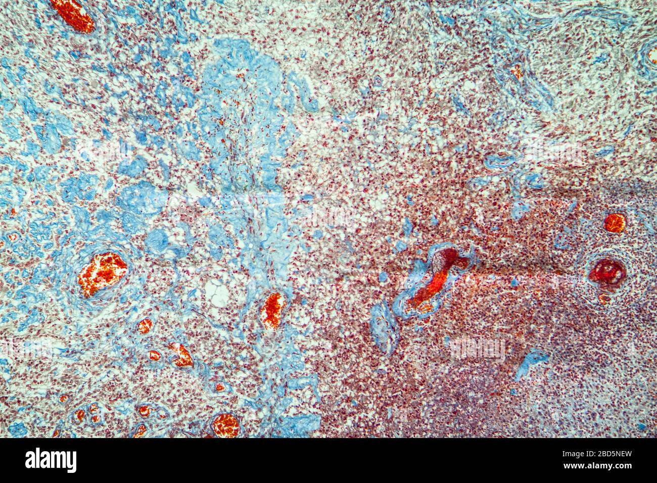 Melanoma skin cancer Diseased tissue 100x Stock Photo - Alamy