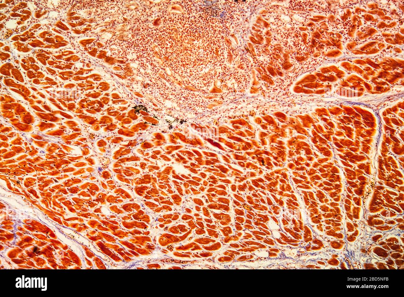 Cardiac muscle inflammation Diseased tissue 100x Stock Photo - Alamy
