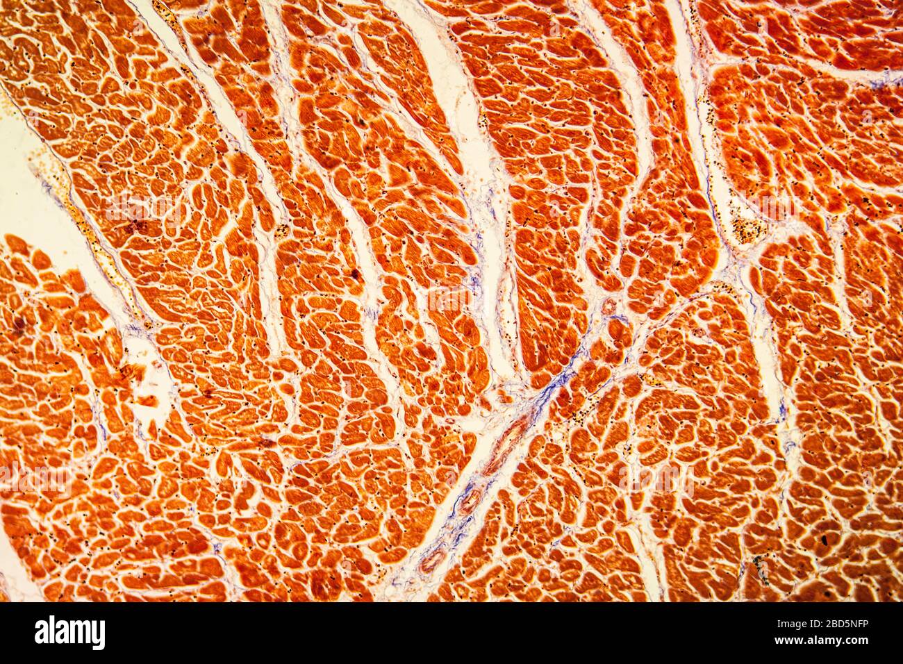 Cardiac muscle inflammation Diseased tissue 100x Stock Photo - Alamy