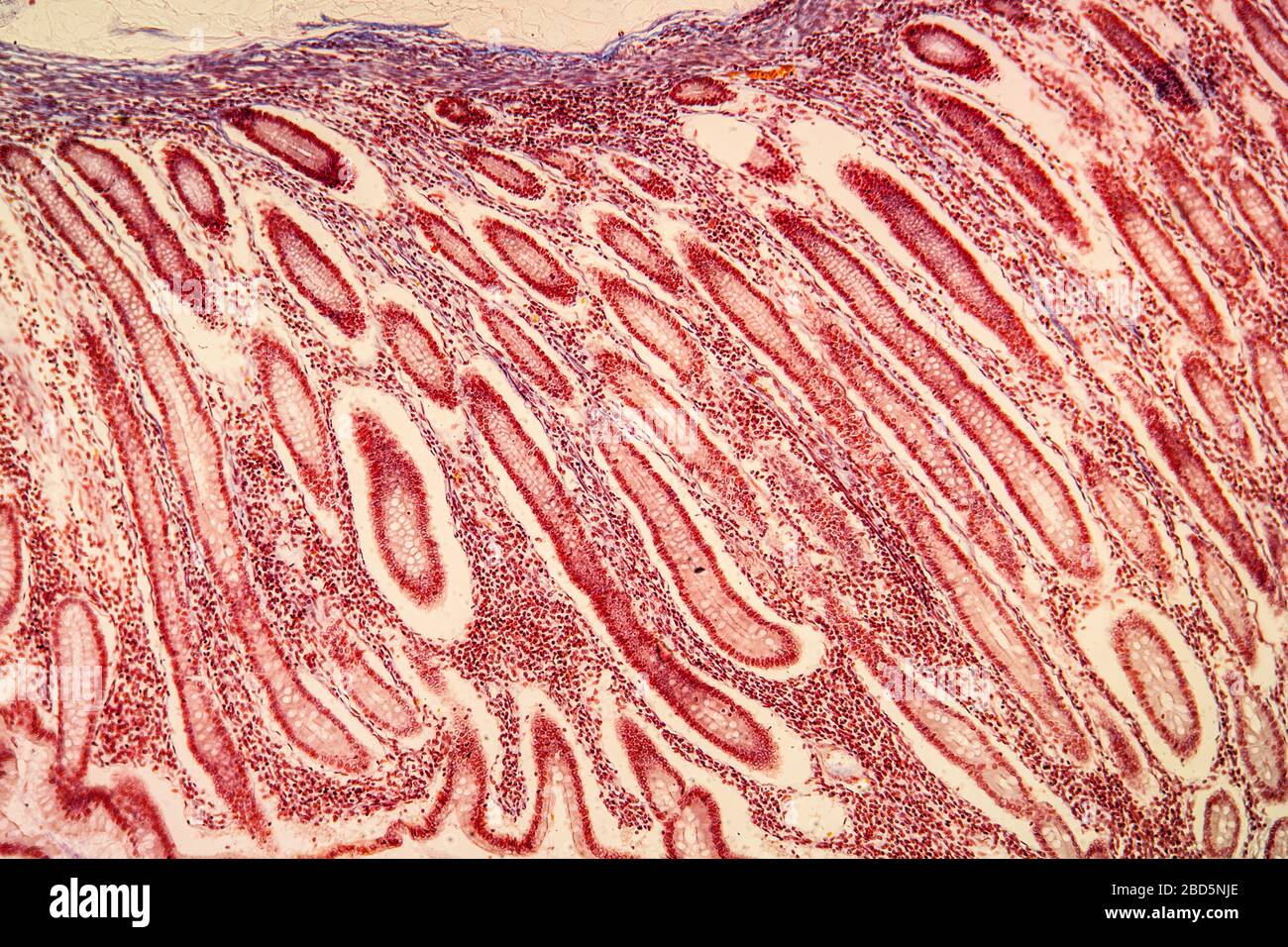 Colon cancer of the colon Diseased tissue 100x Stock Photo - Alamy