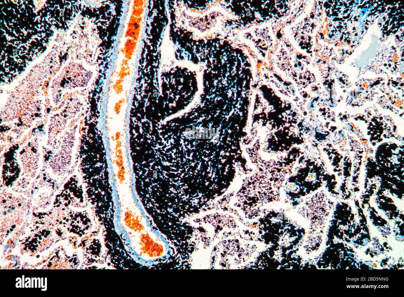 Anthracosis hi-res stock photography and images - Alamy