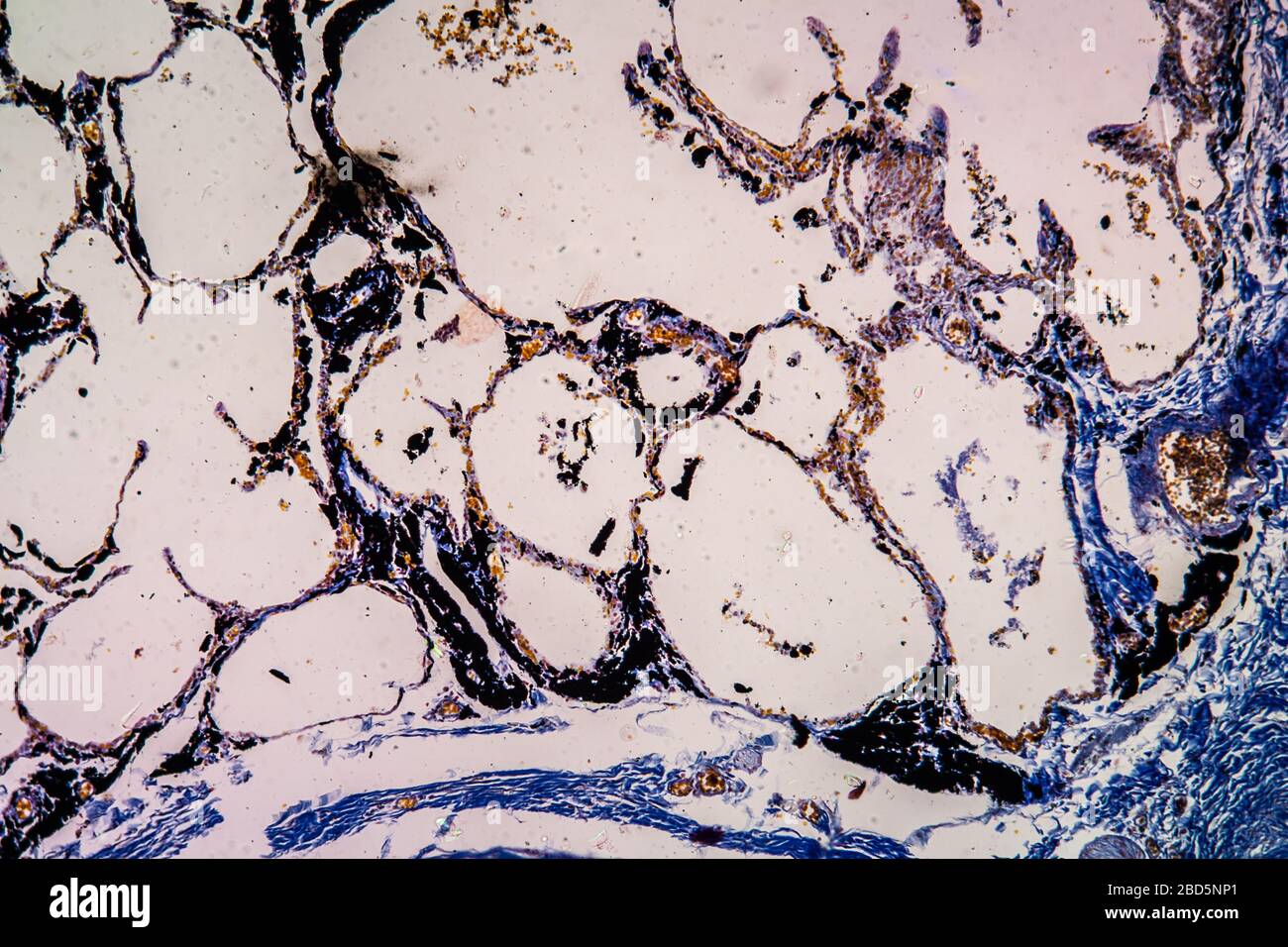 Charcoal dust lung tissue under the microscope 100x Stock Photo - Alamy
