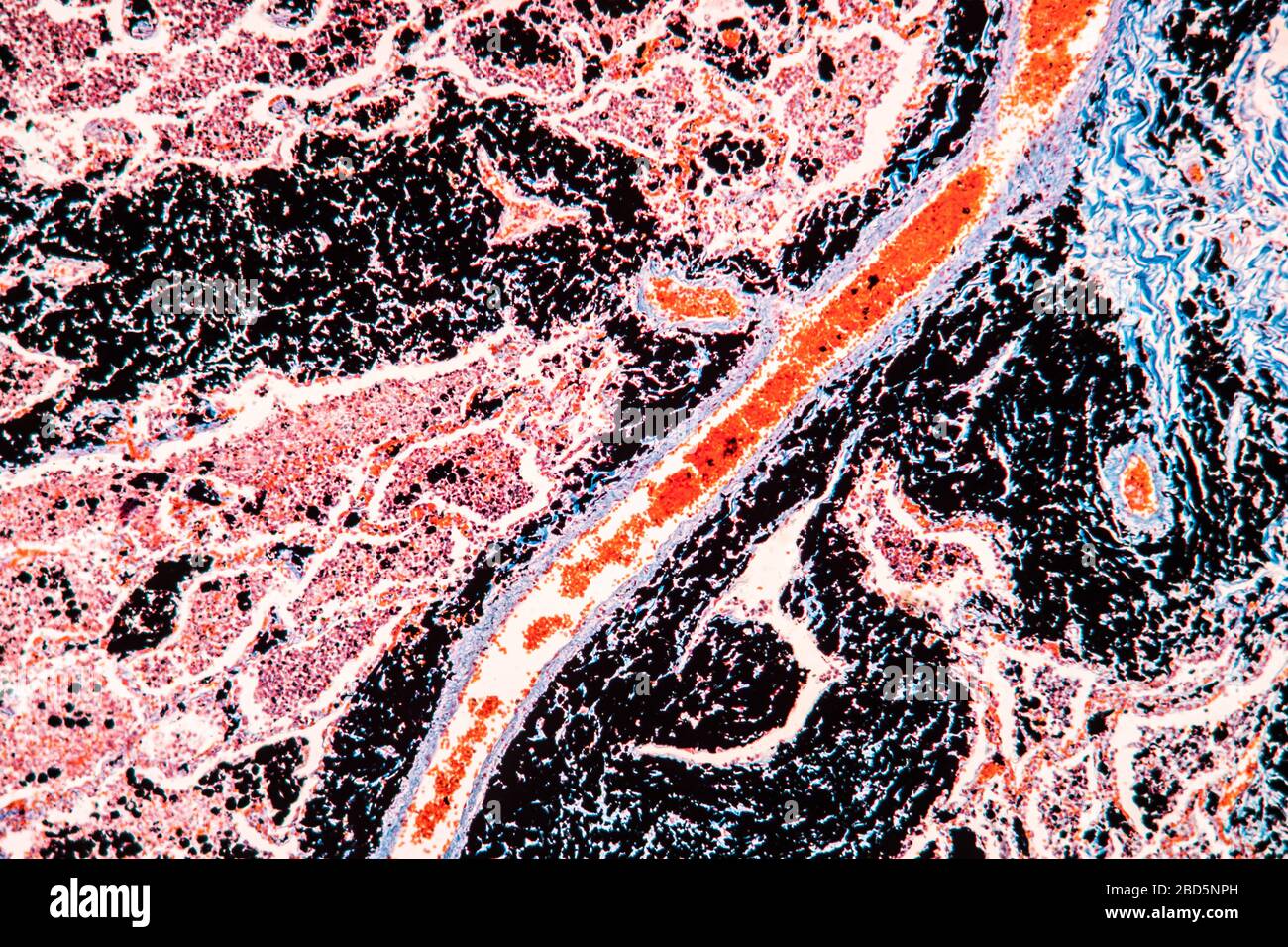 Anthracosis hi-res stock photography and images - Alamy