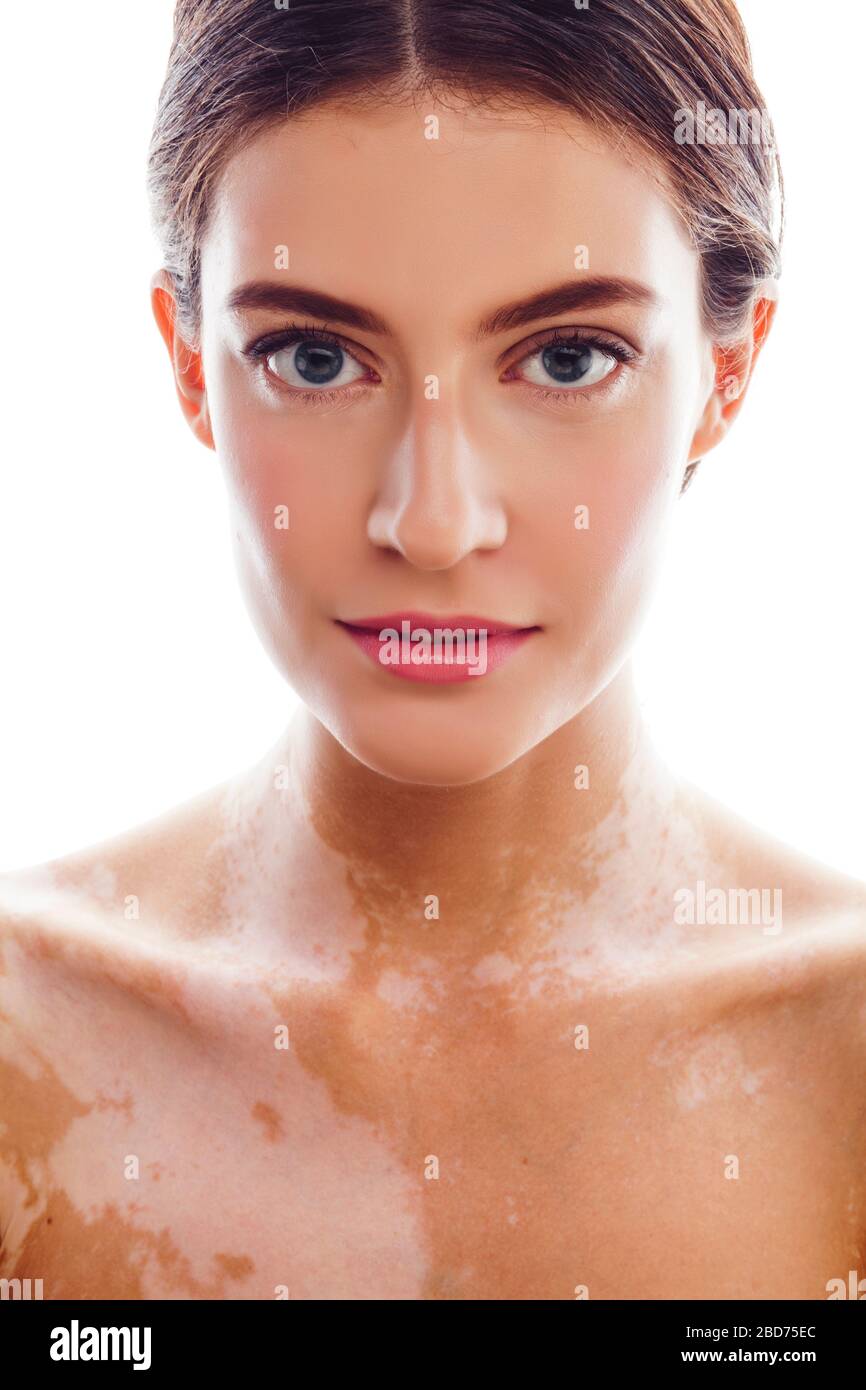 beautiful young brunette woman with vitiligo disease isolated on white ...