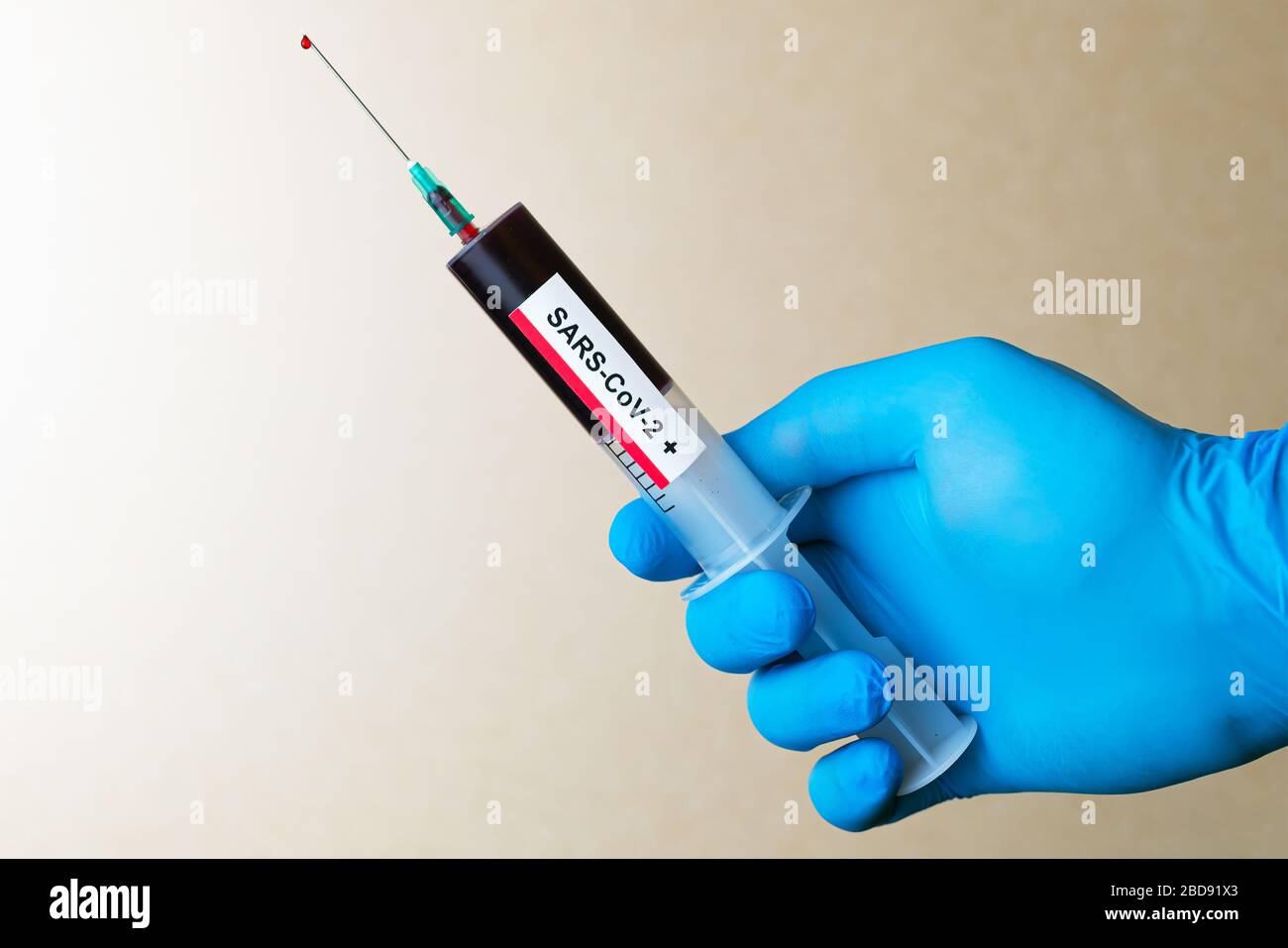 Doctors hand in glove holds syringe with positive Coronavirus blood. A ...