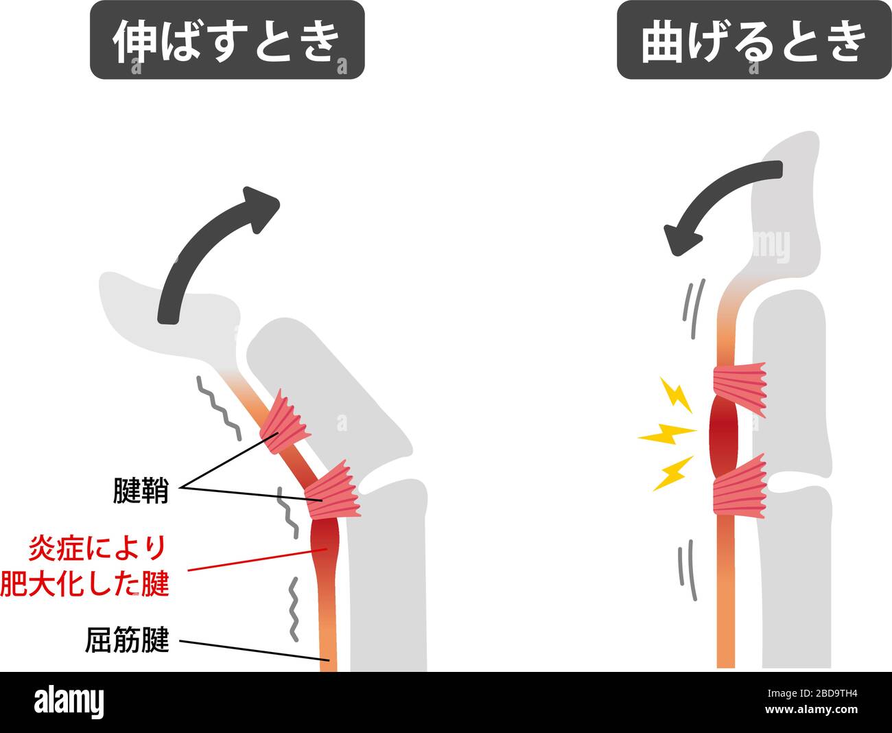 Trigger finger causes and symptoms illustration / Japanese Stock Vector ...