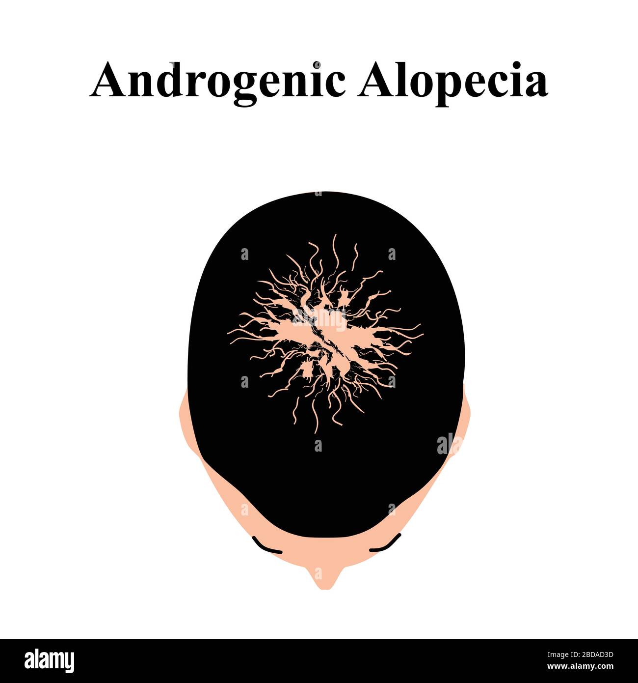 Alopecia Hair Baldness Of Hair On The Head Androgenic Alopecia