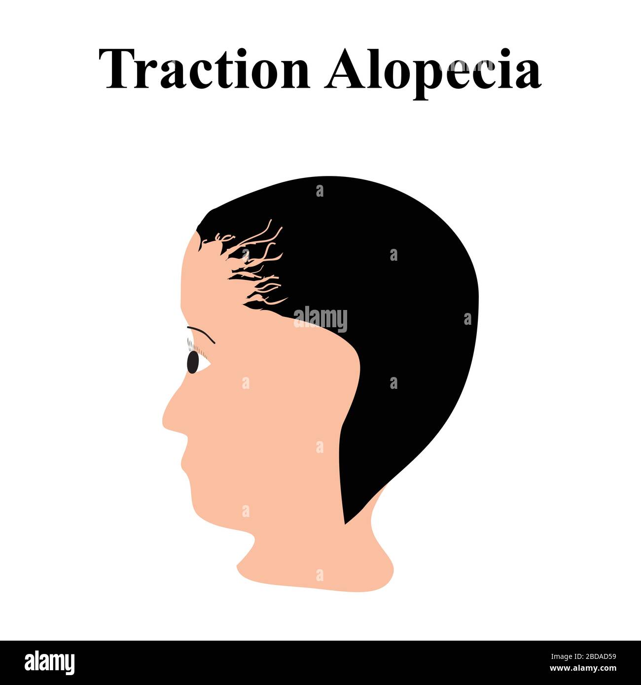 Alopecia Hair Baldness Of Hair On The Head Traction Alopecia