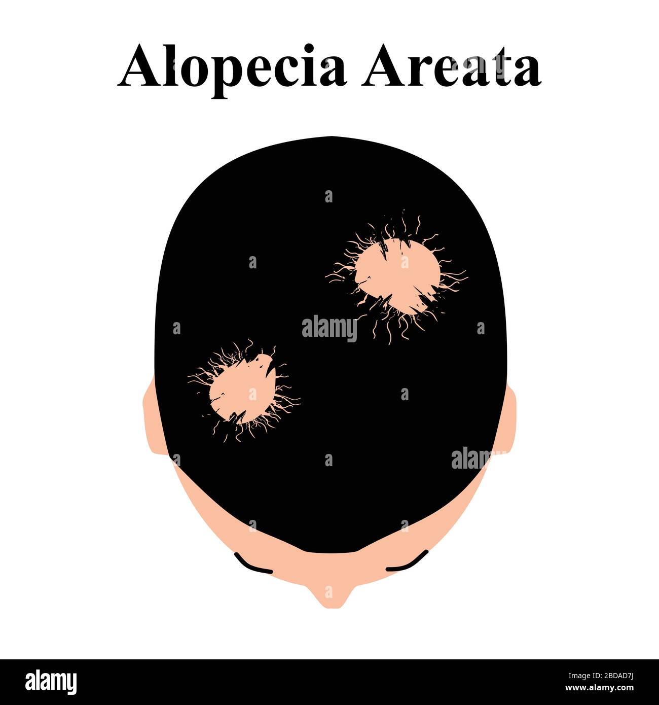 Alopecia areata hi-res stock photography and images - Alamy
