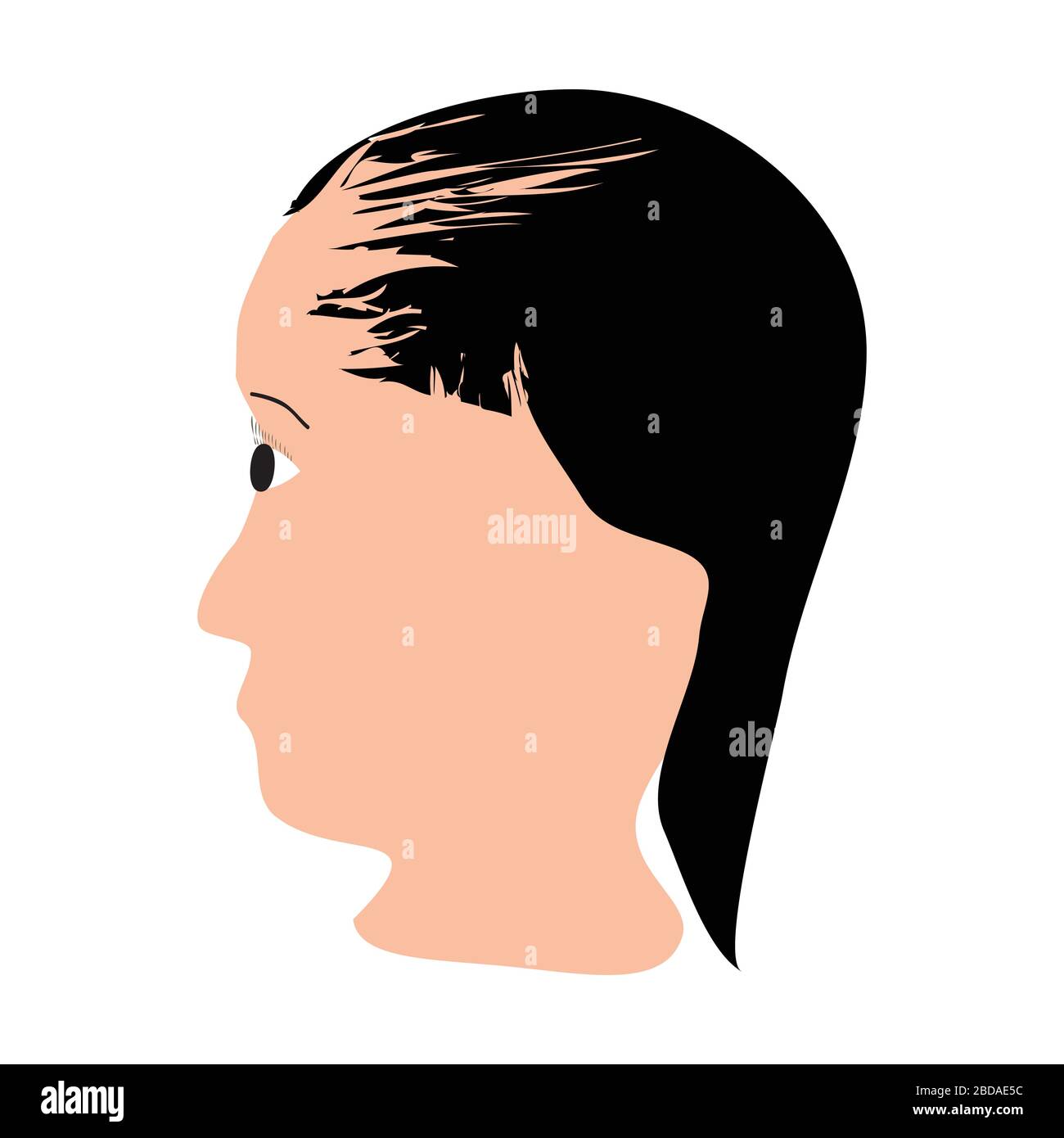 Alopecia Hair Baldness Of Hair On The Head Telogen Alopecia