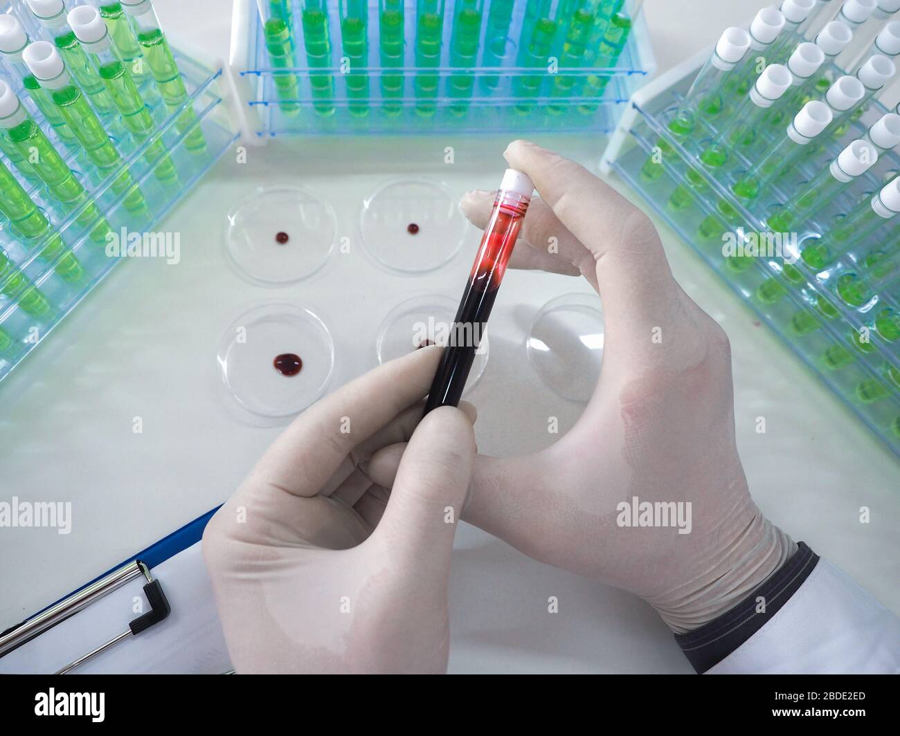 Photo of diseased blood sample in a test tube in a researcher's hands ...