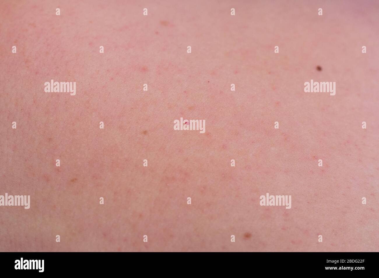 Benign nevus skin dermatology hi-res stock photography and images - Alamy