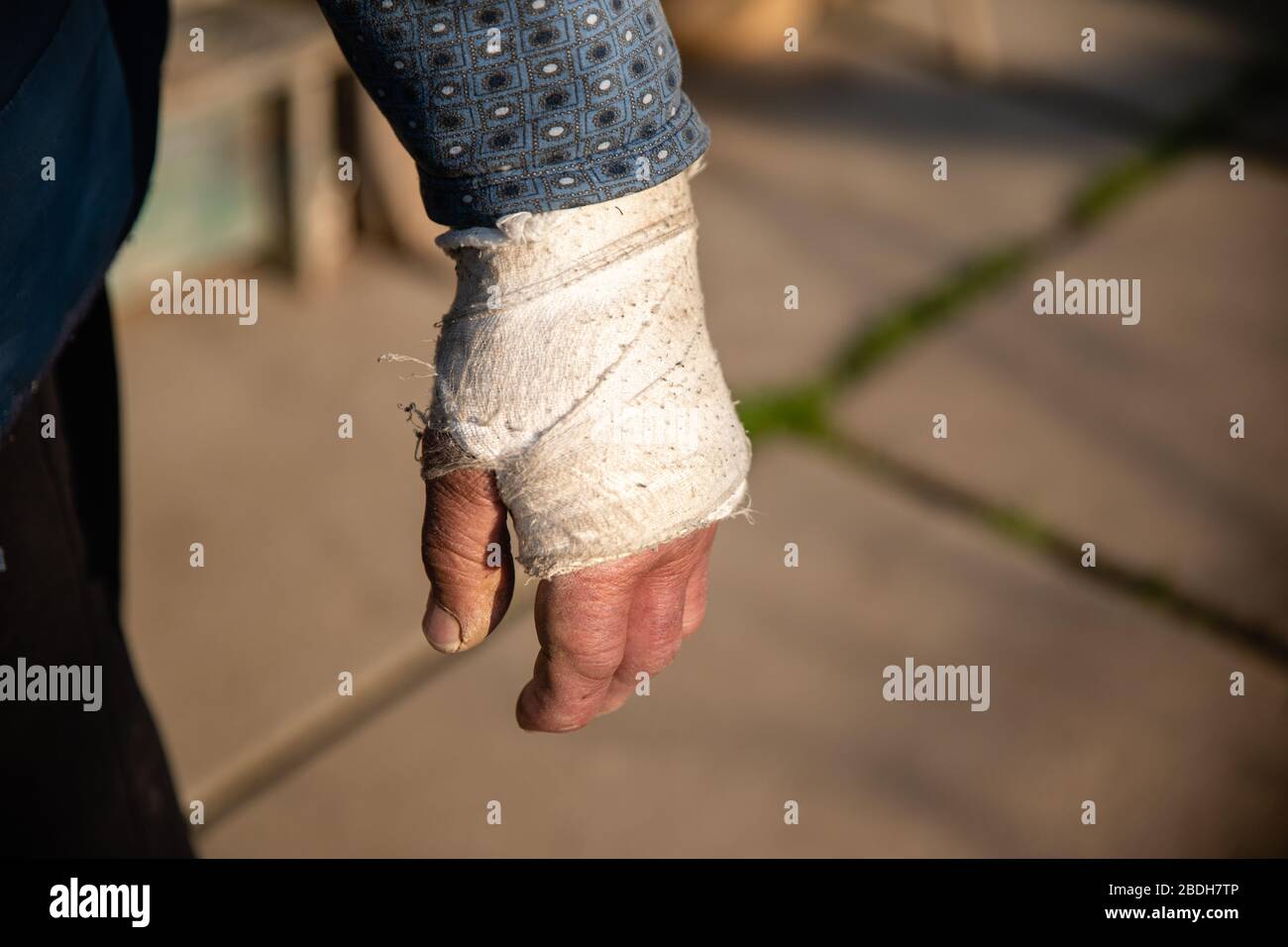 Elderly broken arm hi-res stock photography and images - Alamy