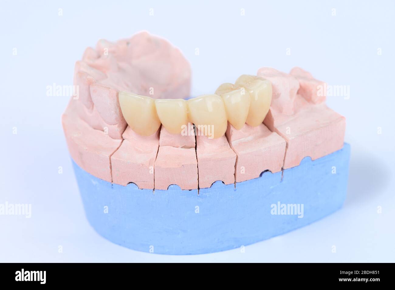 Ceramic tooth crown on plaster model Stock Photo - Alamy