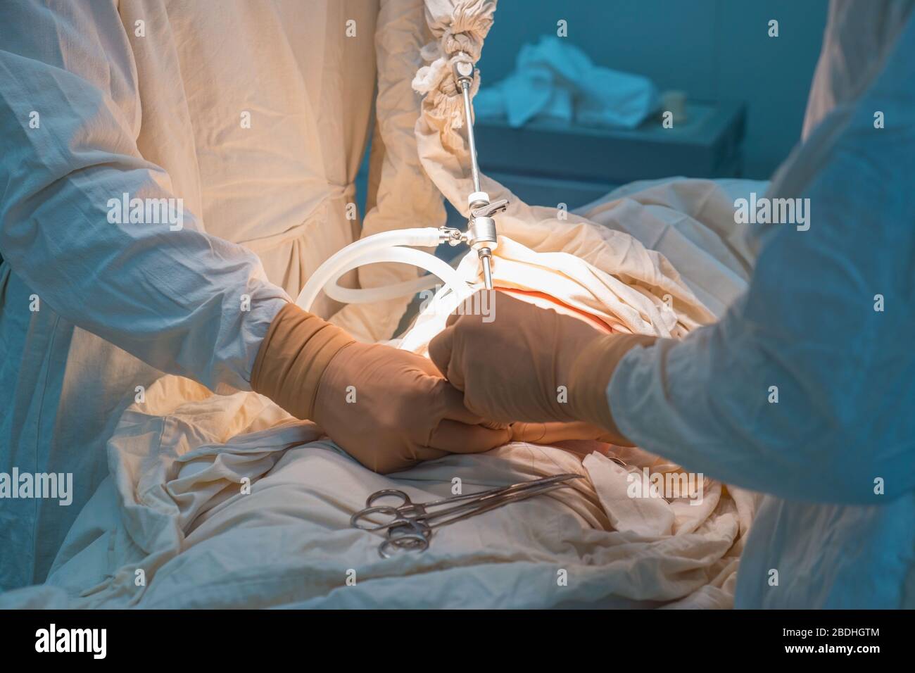 close-up hands of pediatric surgeons perform surgery using laparoscopic ...