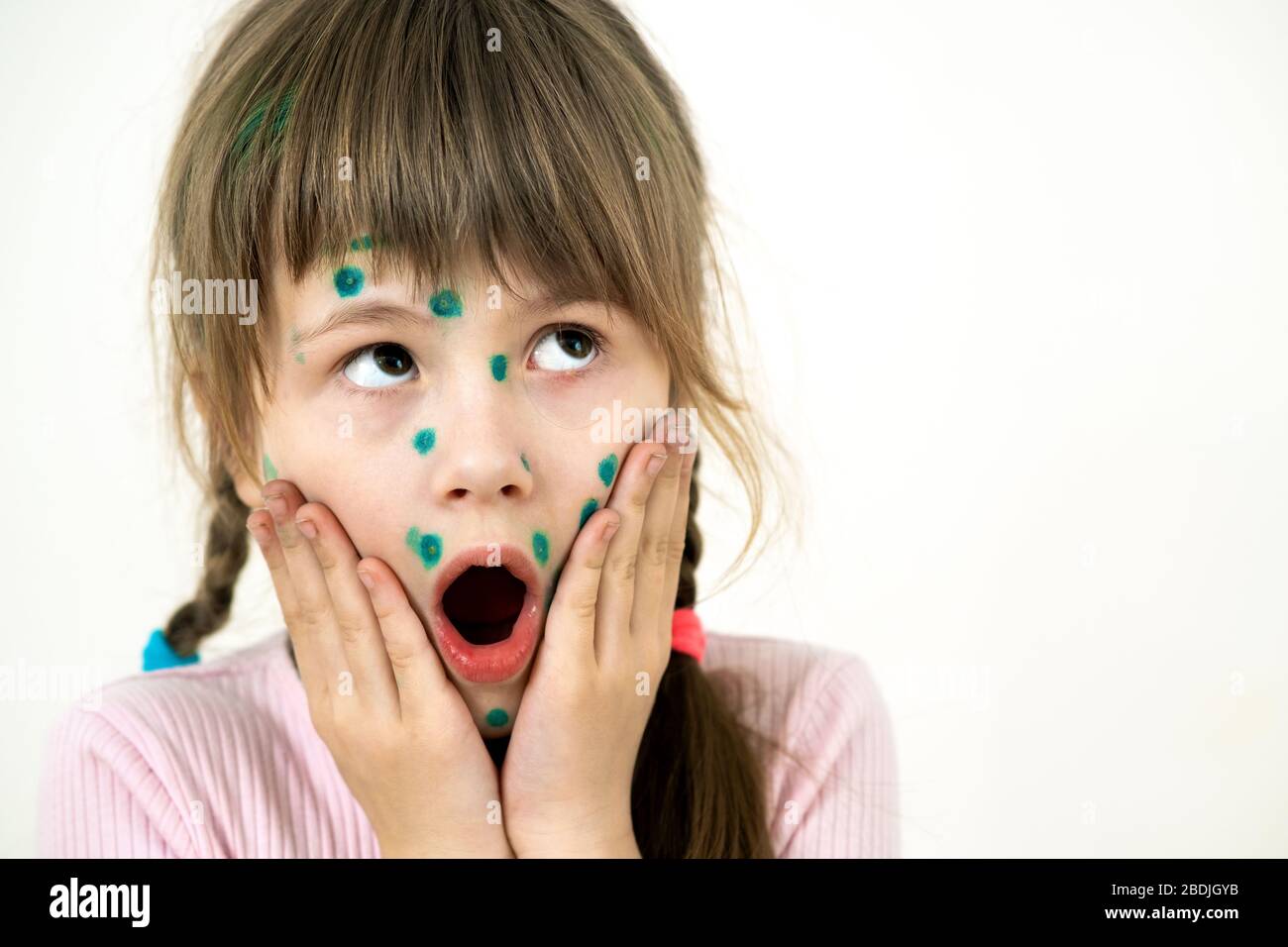 Child girl covered with green rashes on face ill with chickenpox ...