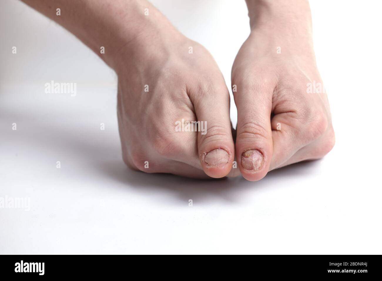 Close up of nail fungus infection. Fungal infection on nails hand ...
