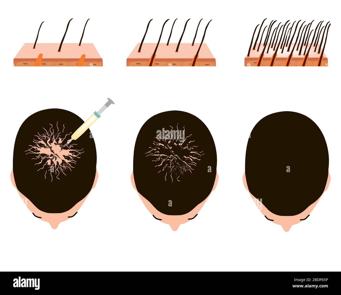 Treatment Of Alopecia Bald Spot Baldness Alopecia Mesotherapy
