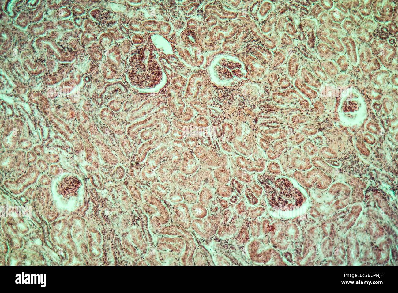 Kidney tuberculosis Diseased tissue 100x Stock Photo - Alamy