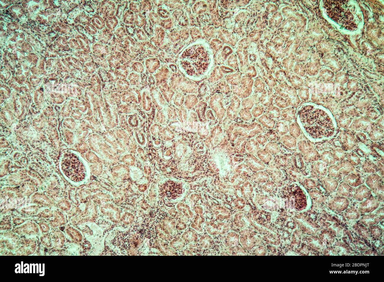 Kidney tuberculosis Diseased tissue 100x Stock Photo - Alamy