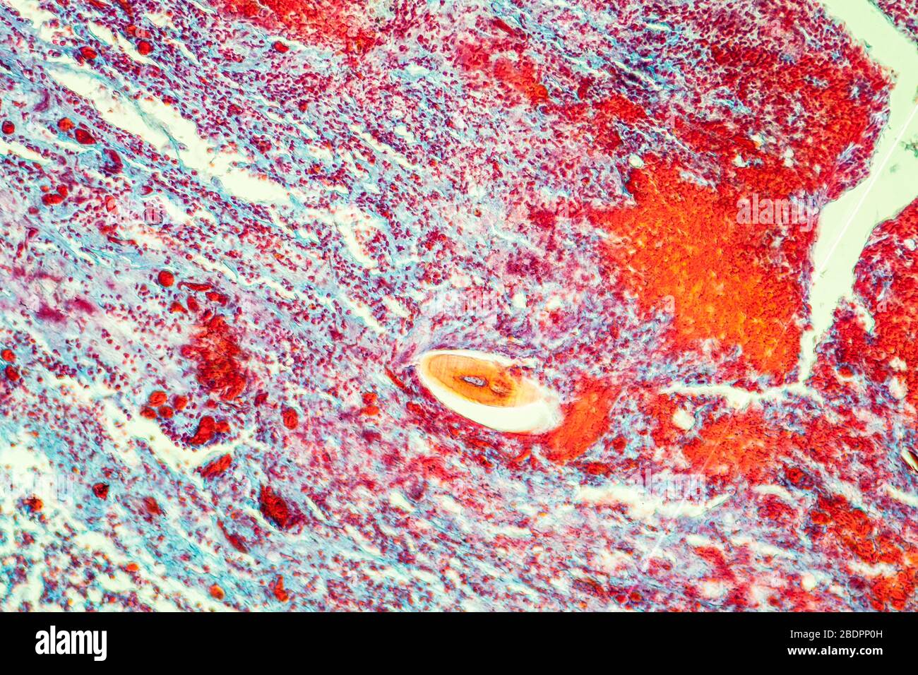Scabies mites skin hi-res stock photography and images - Alamy
