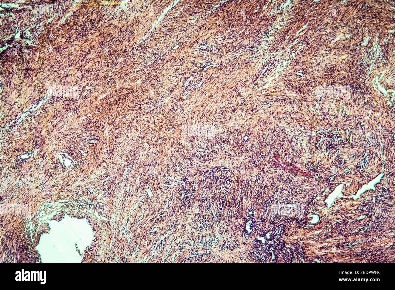 Cardiac muscle inflammation diseased tissue 100x Stock Photo - Alamy