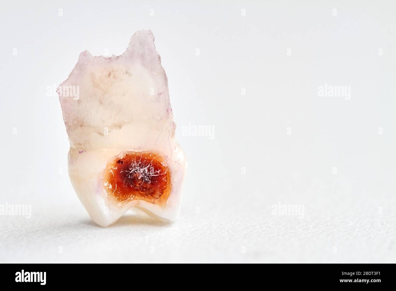 Dental caries on primary tooth. Deciduous tooth with caries on light ...