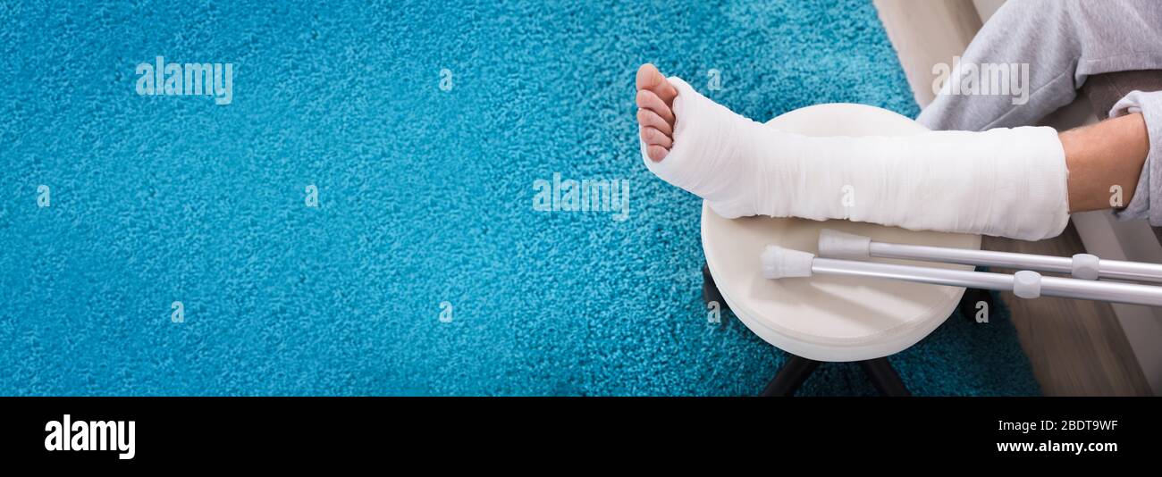 Broken Leg Bone In Cast And Crutches Stock Photo - Alamy