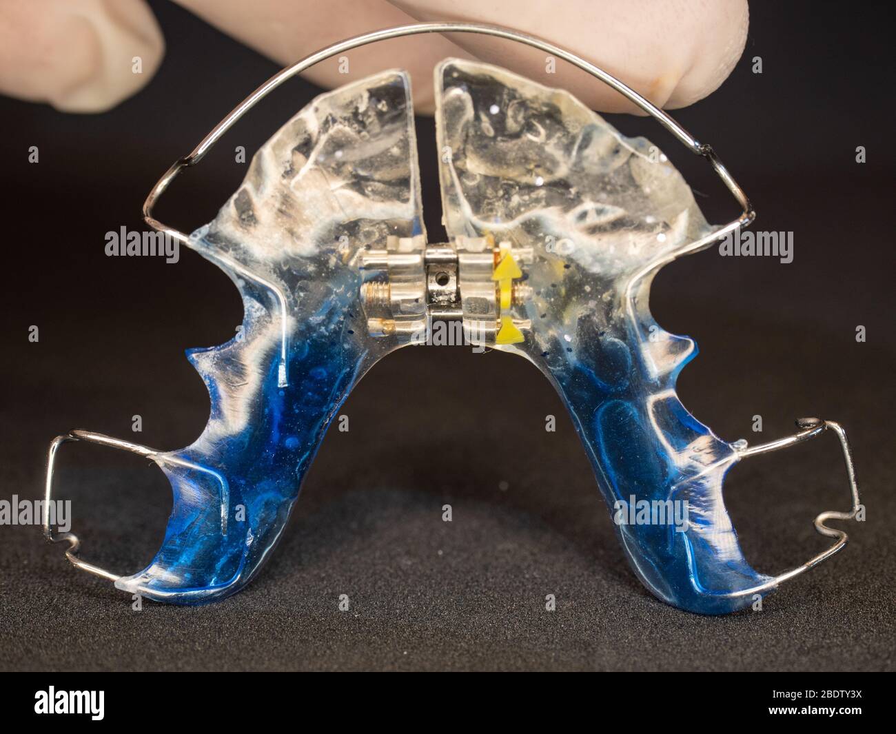 Dental Blue Removable Brace or Retainer for Teeth Orthodontic in medic ...