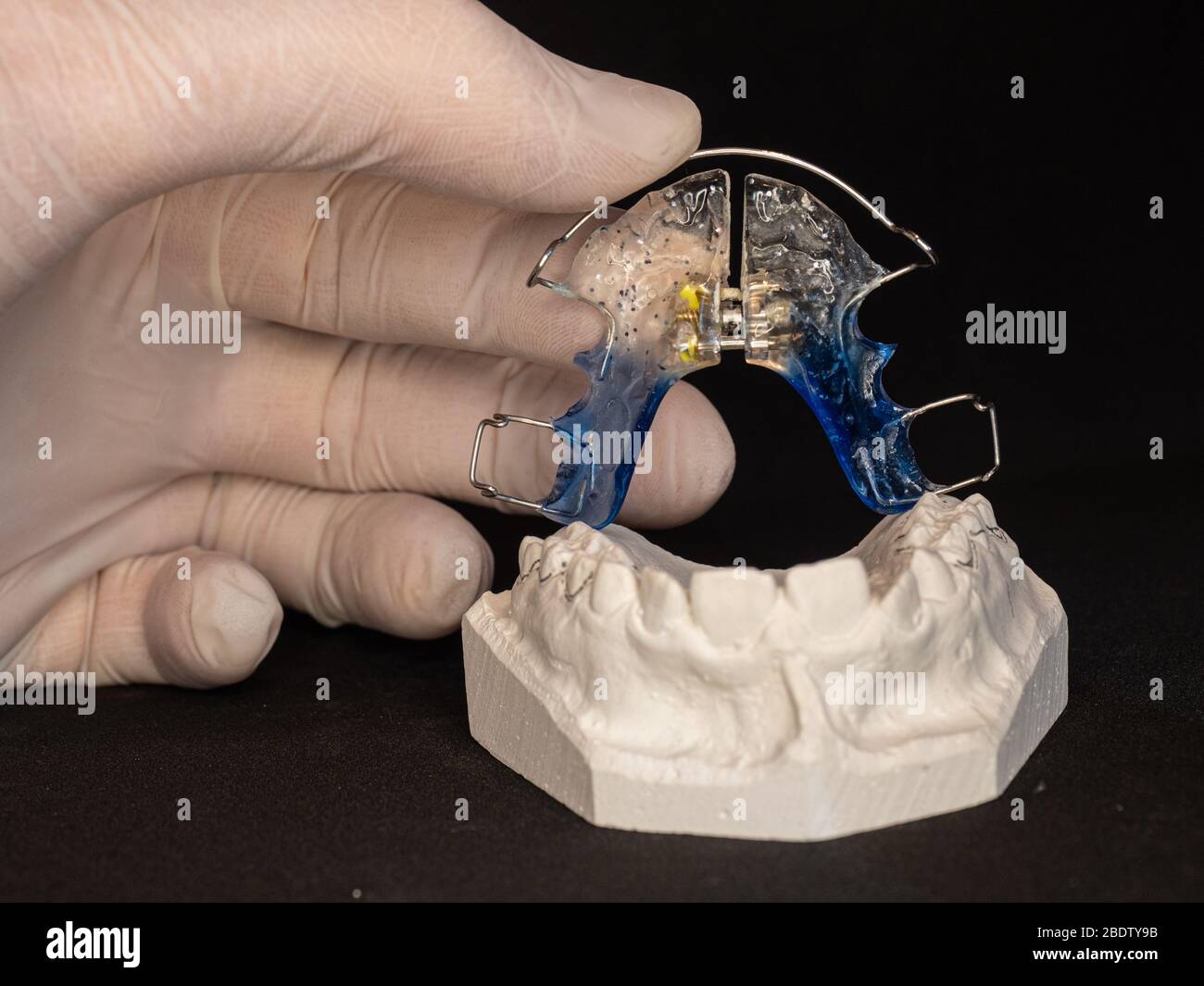 Plaster cast of teeth with removable partial orthodontic removable ...
