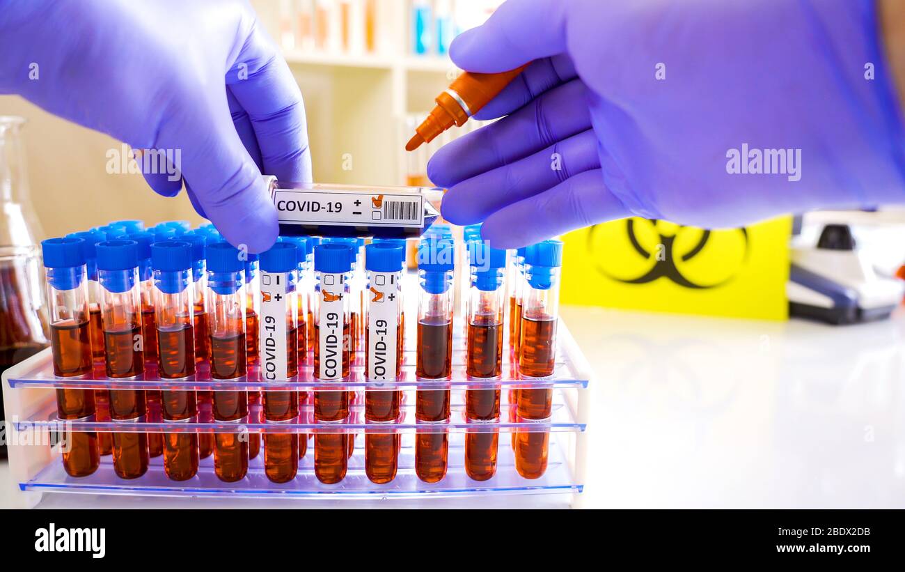 A doctor in the lab checking the test sample positive for coronavirus ...