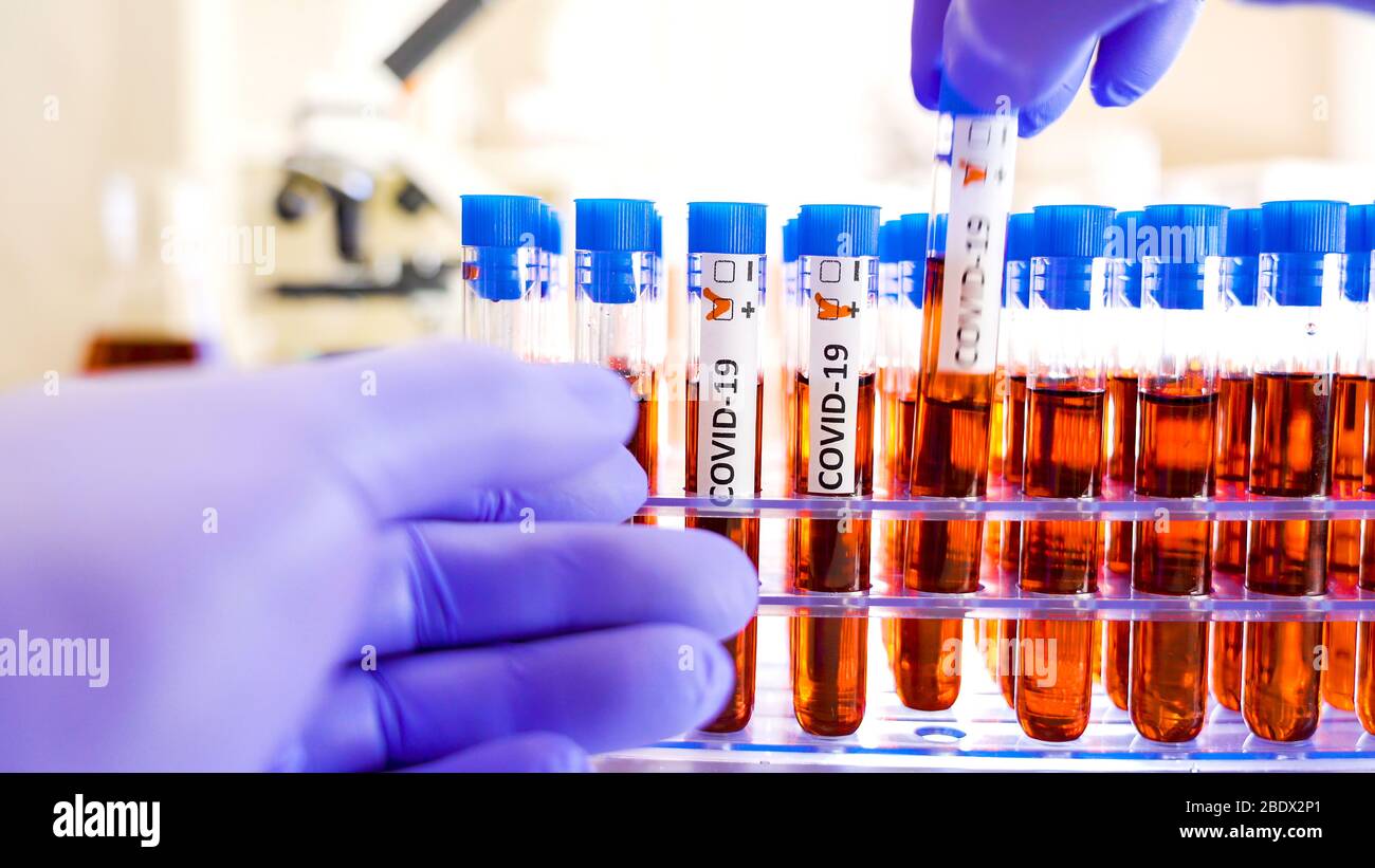 A lab doctor marking the test tube with positive for coronavirus with ...