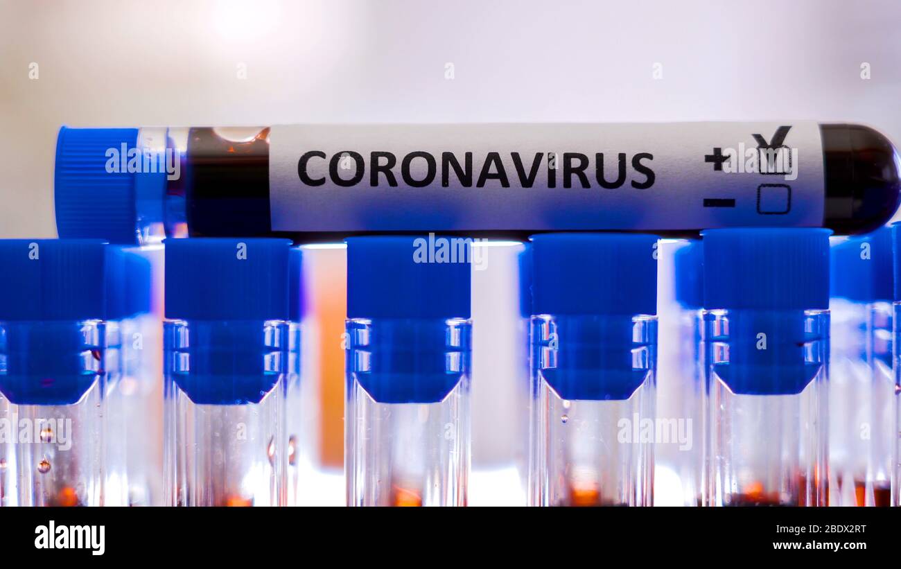 A test kit filled with blood sample positive for coronavirus on top of ...