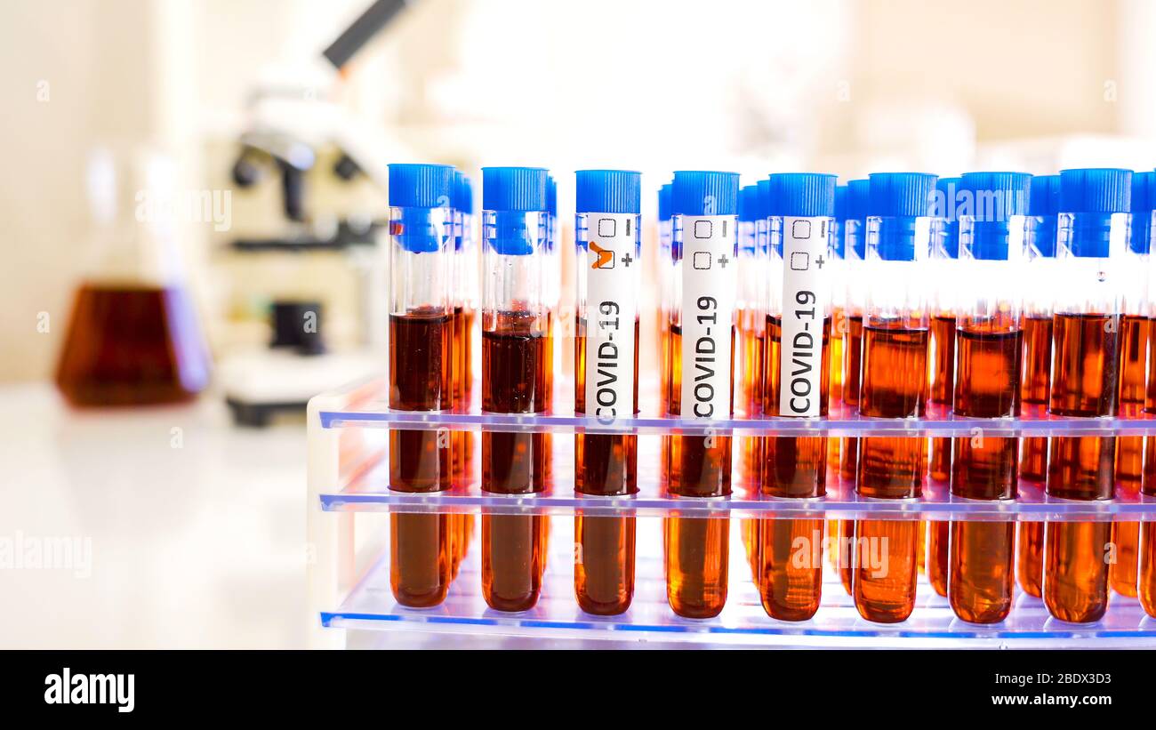 Marking the test sample for COVID-19 coronavirus into positive using ...