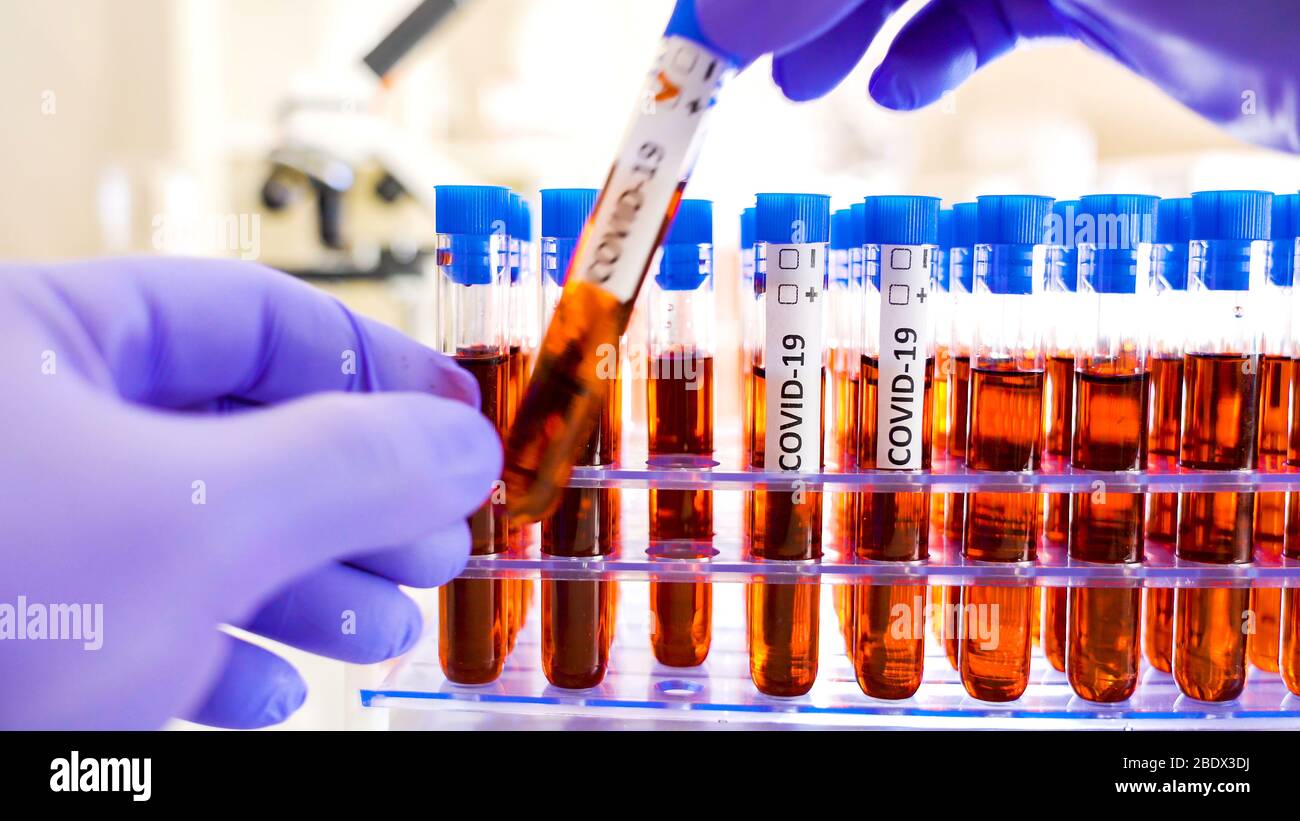 Marking the test sample for COVID-19 coronavirus into positive using ...