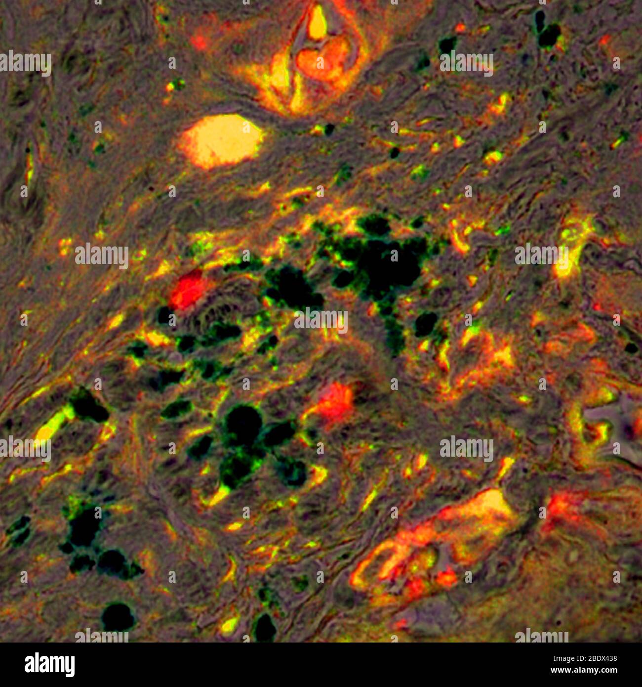 Nanoparticles in pancreatic tumor hi-res stock photography and images ...