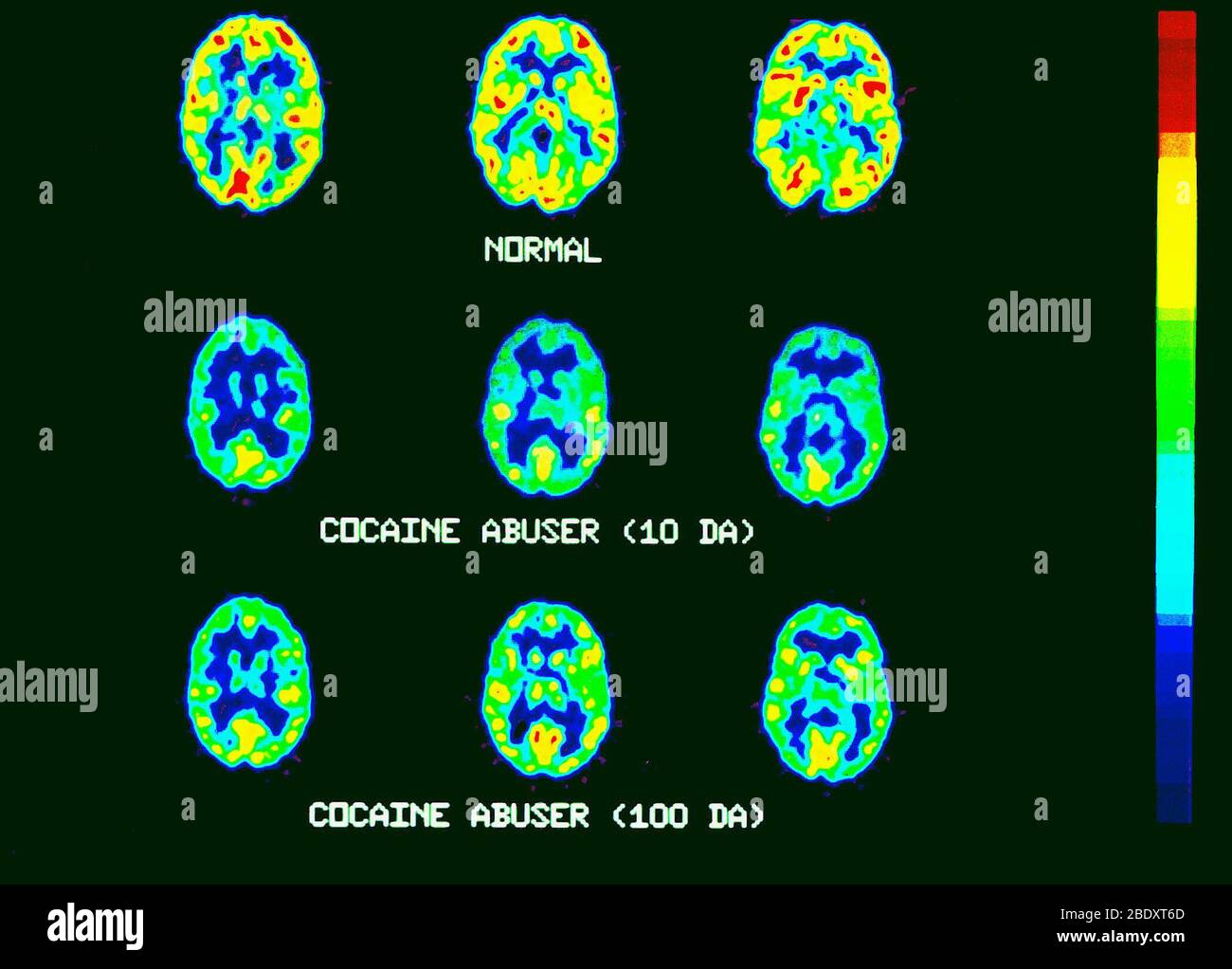 PET Scans, Normal and Cocaine-Abuser Stock Photo - Alamy