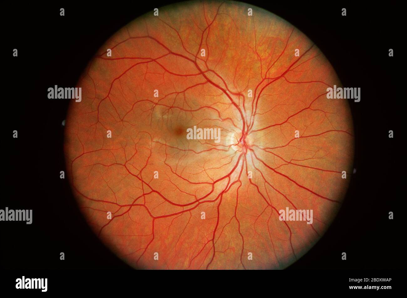 Normal retina ophthalmoscope hi-res stock photography and images - Alamy Normal retina ophthalmoscope hi-res stock photography and images - Alamy