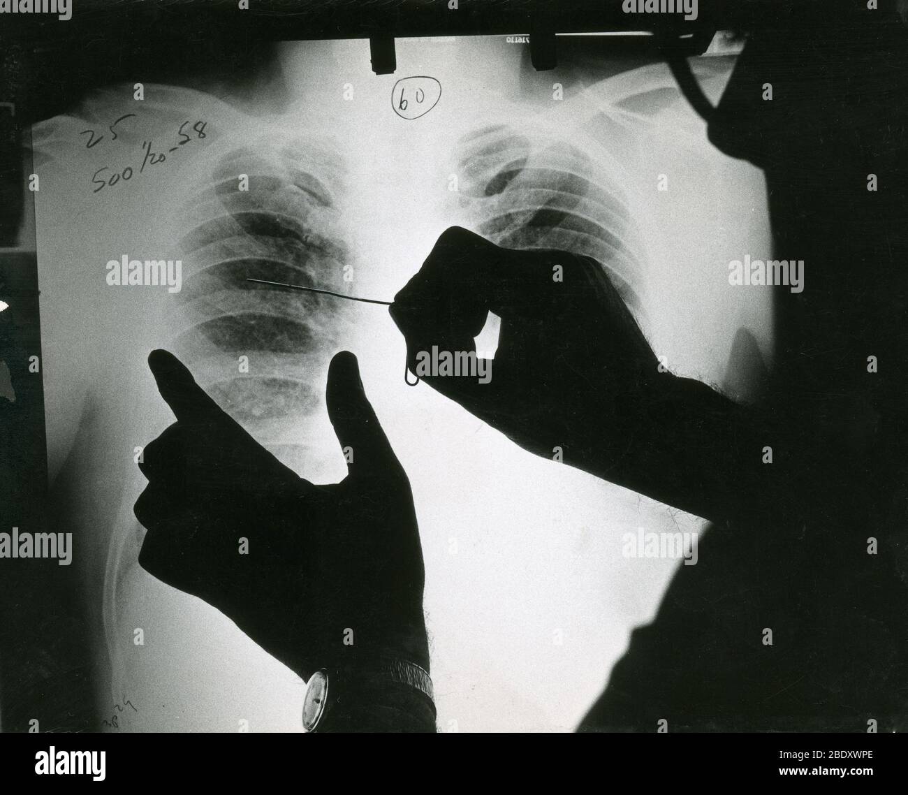 Black lung disease hi-res stock photography and images - Alamy